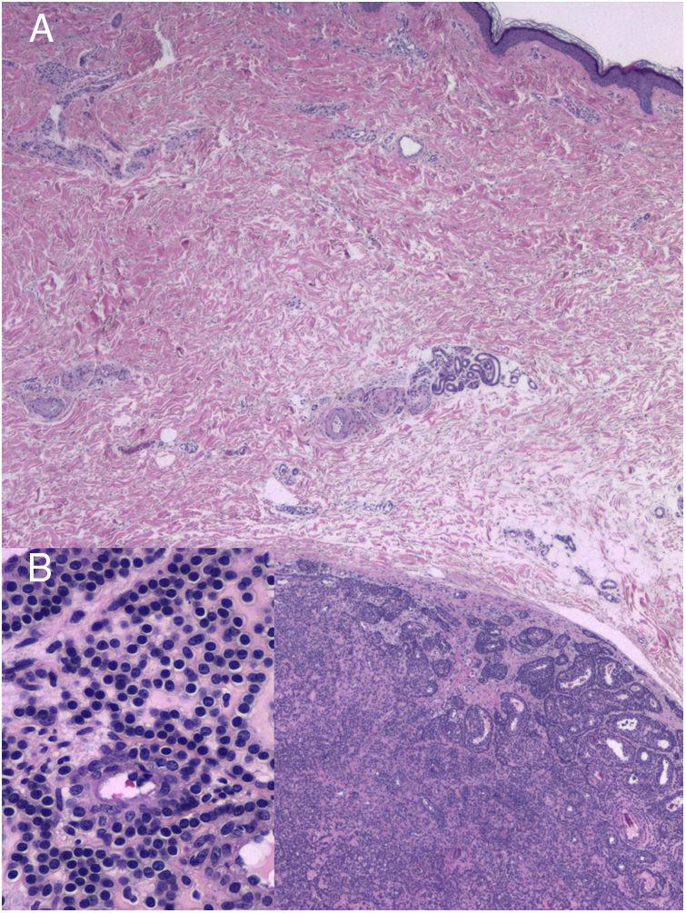 Solitary Glomus Tumor Presenting as a Telangiectatic Macule | Actas ...