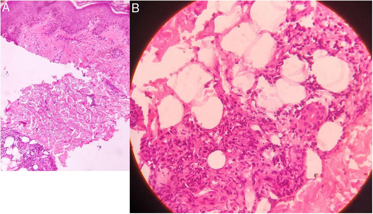 Borderline Tuberculoid Leprosy in Erythema Nodosum Leprosum Reaction ...