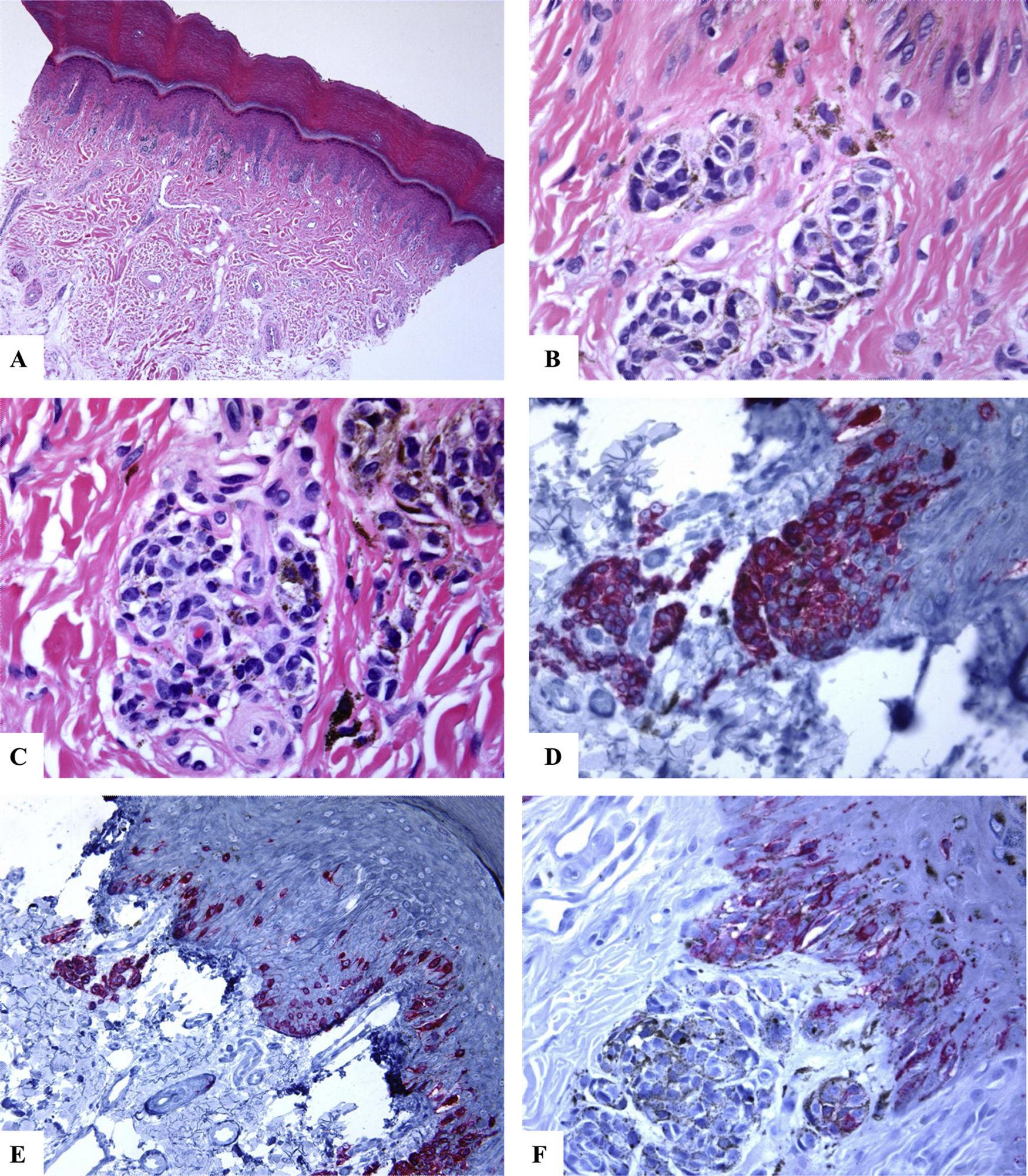 Melanocytic Nevi with Site-related Atypia: A Case Series and ...