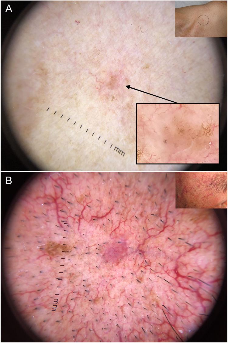 Morpheaform Basal Cell Carcinoma