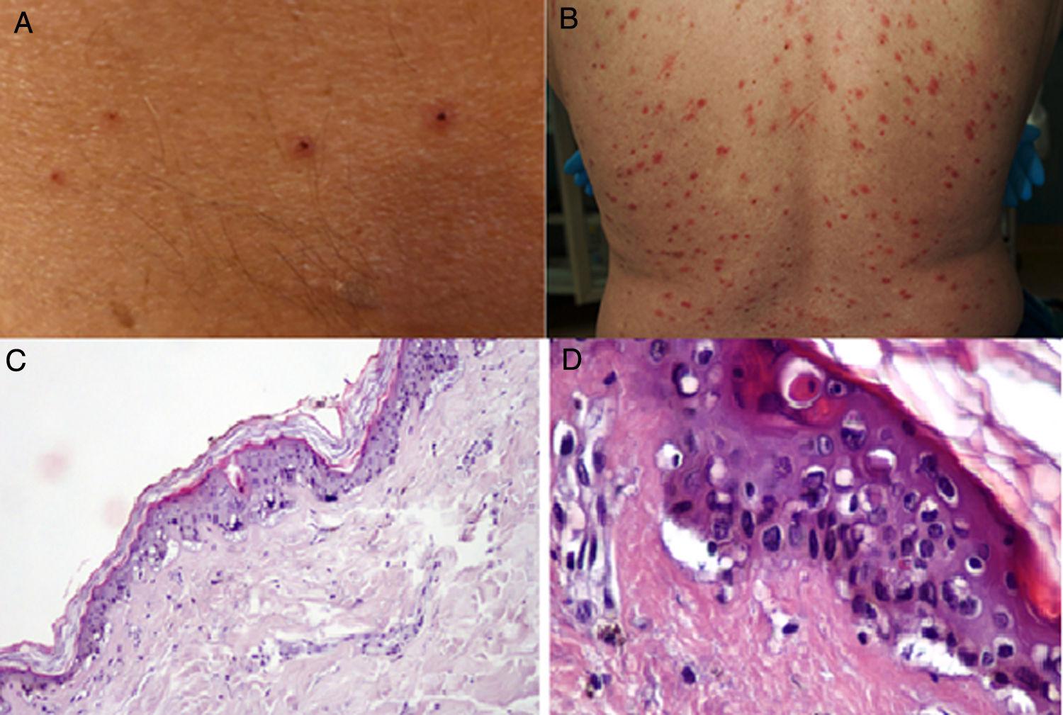 Cutaneous Manifestations in Patients With COVID-19: Clinical ...