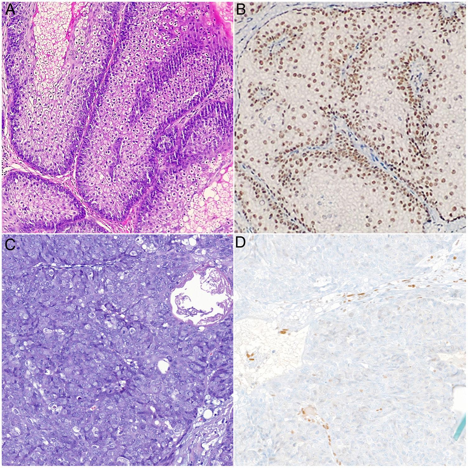 Eruptions of sebaceous adenomas and carcinomas induced by tacrolimus ...