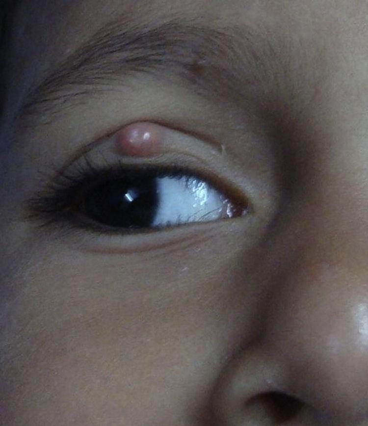 An Efficacy of Cantharidin Treatment in Facial Molluscum Contagiosum in ...