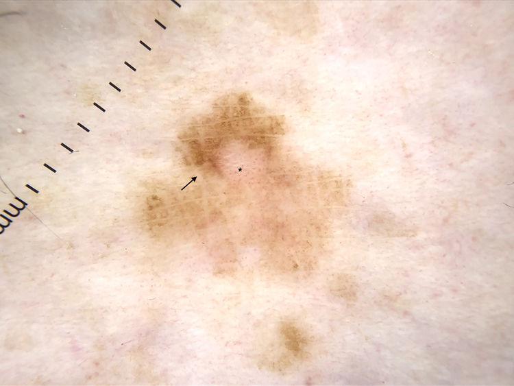 Prominent Skin Markings: A New Reason to Suspect Melanoma | Actas Dermo ...