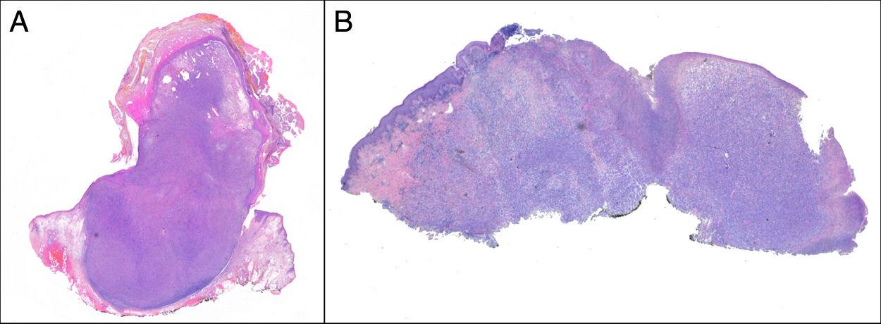 Relation Between Atypical Fibroxanthoma and Pleomorphic Dermal Sarcoma ...
