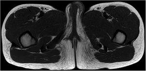 Asymmetric Hypertrophy of the Labium Majus in a 9-Year-Old Girl | Actas ...