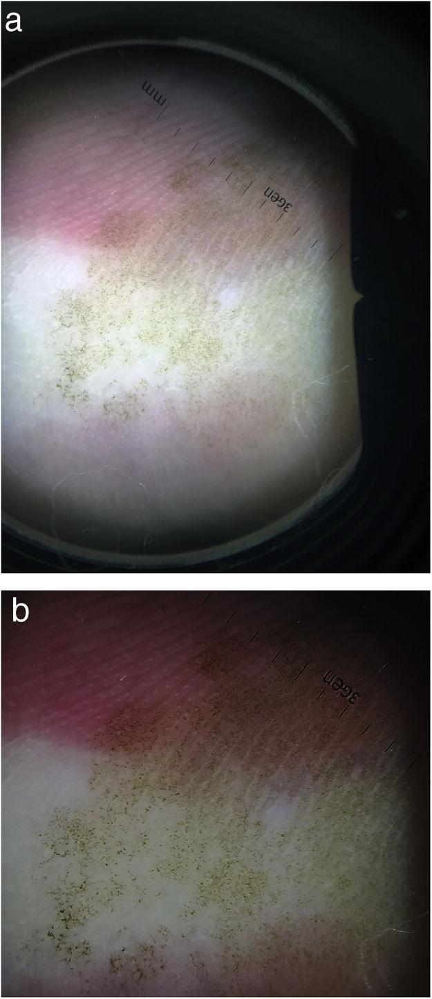 Tinea Nigra: Dermoscopic Findings | Actas Dermo-Sifiliográficas