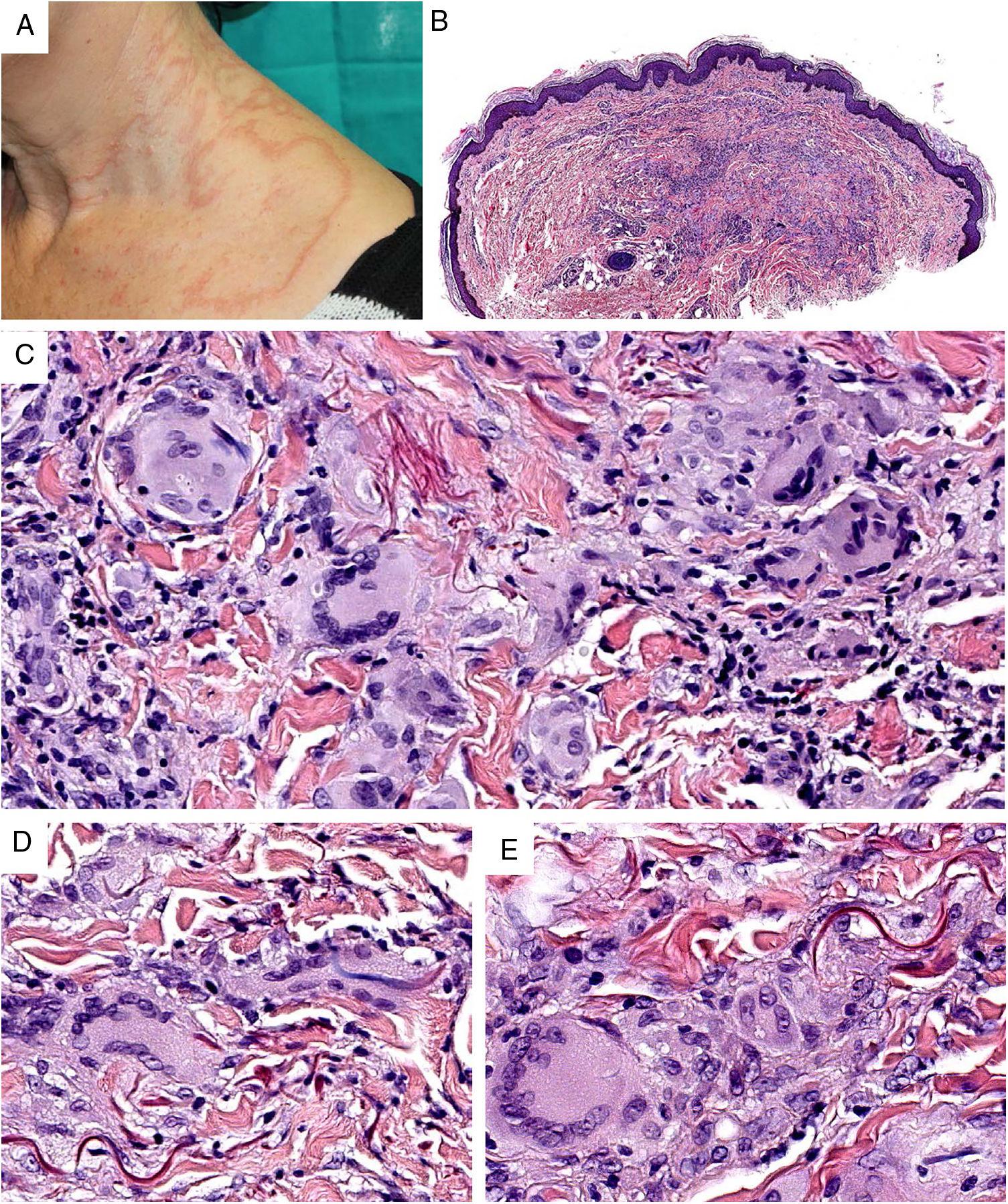 Granulomas in Dermatopathology: Principal Diagnoses — Part 2 | Actas ...