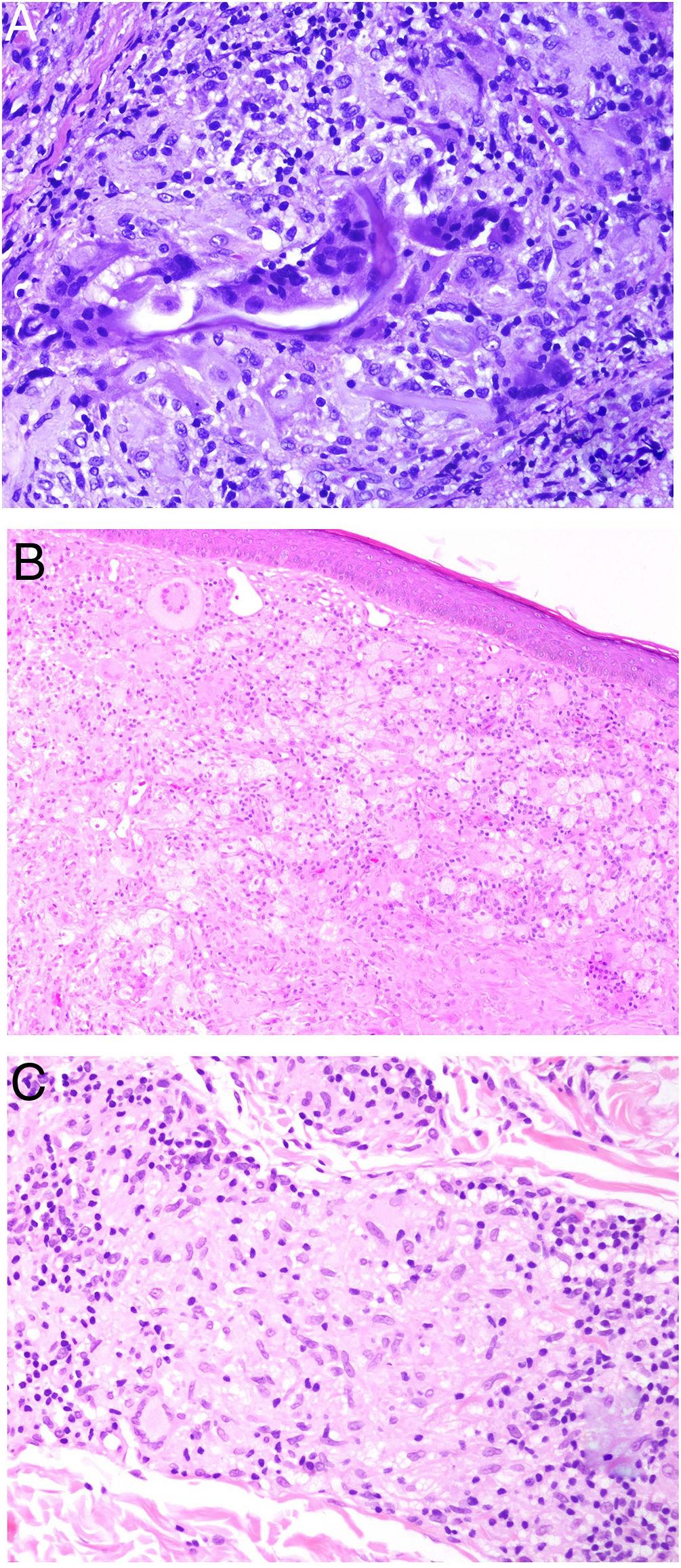 Peripheral Giant Cell Granuloma Histology