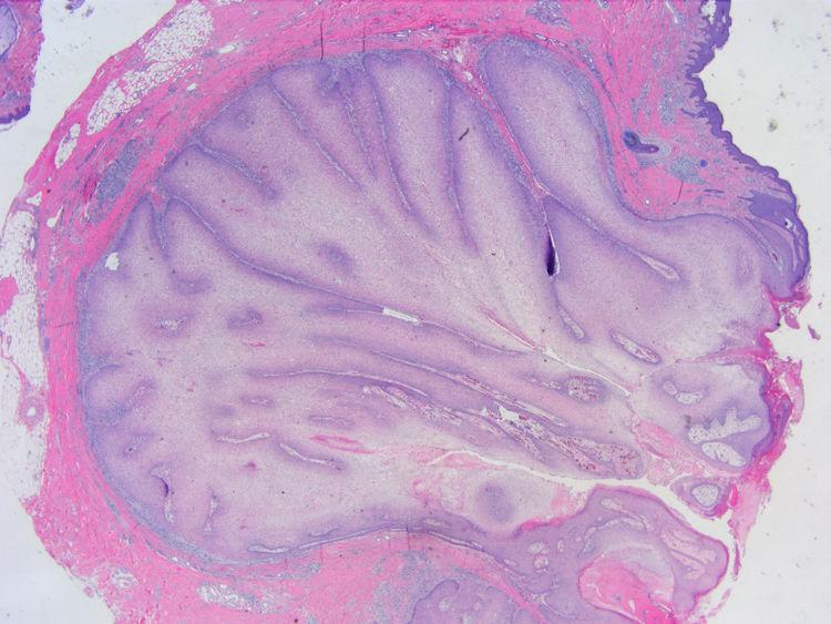 Crateriform Tumor of 2 Years’ Duration | Actas Dermo-Sifiliográficas