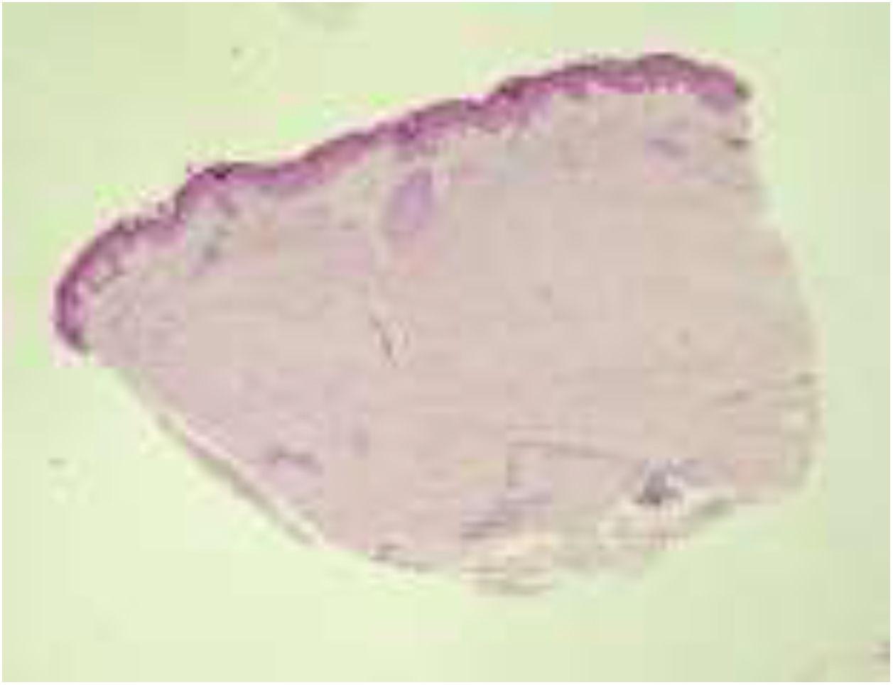Keloid Histology