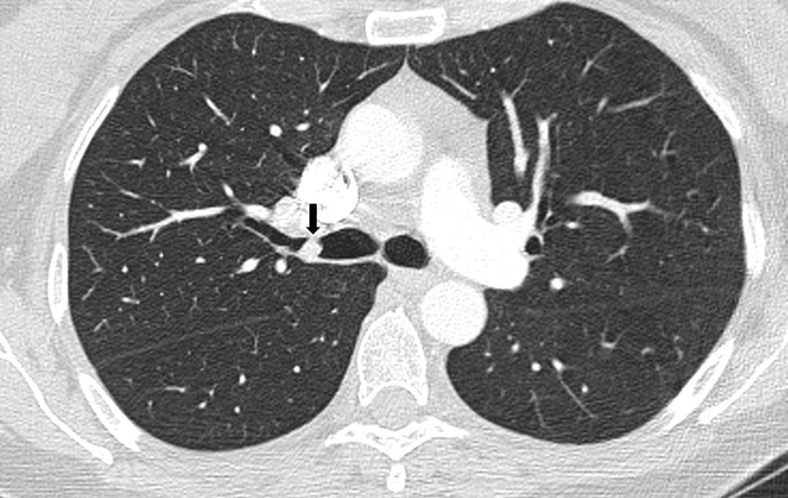 Sclerosing Pneumocytoma Presenting as Endobronchial Tumor With Negative ...