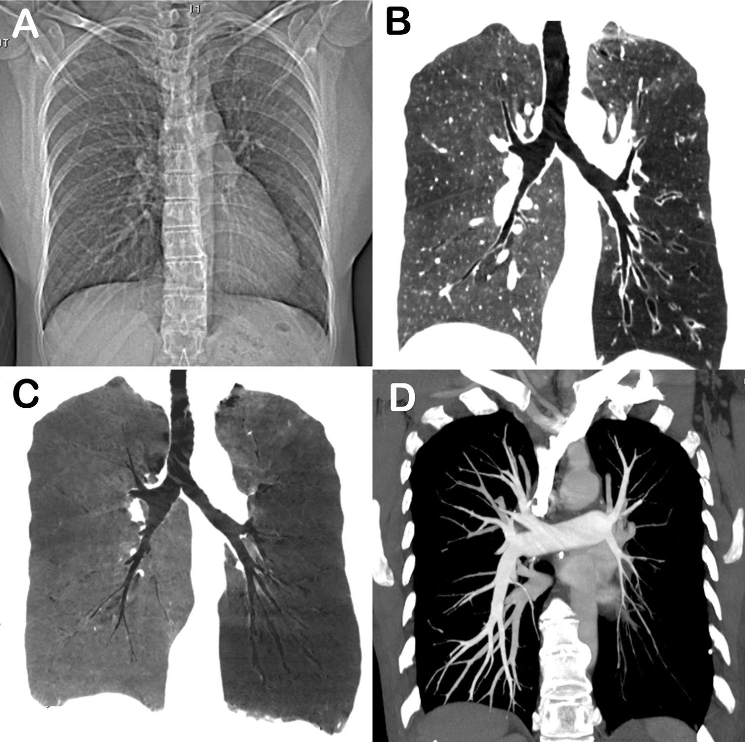 Swyer-James-MacLeod Syndrome | Archivos de Bronconeumología