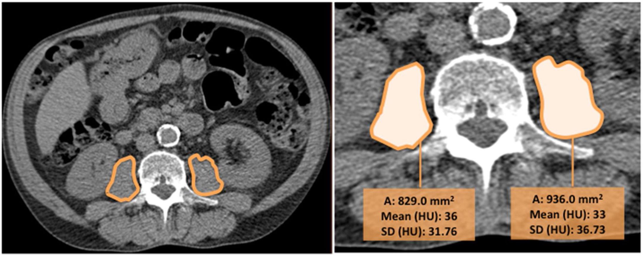 Psoas Muscle Density Evaluated by Chest CT and Long-Term Mortality in ...
