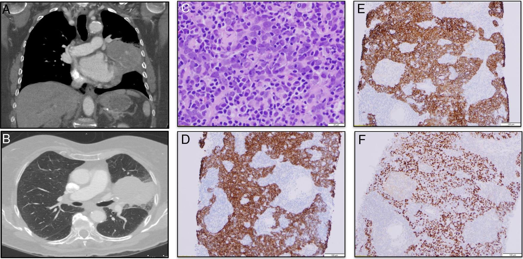 88-Year-Old Woman With an Incidental Lung Mass | Archivos de ...