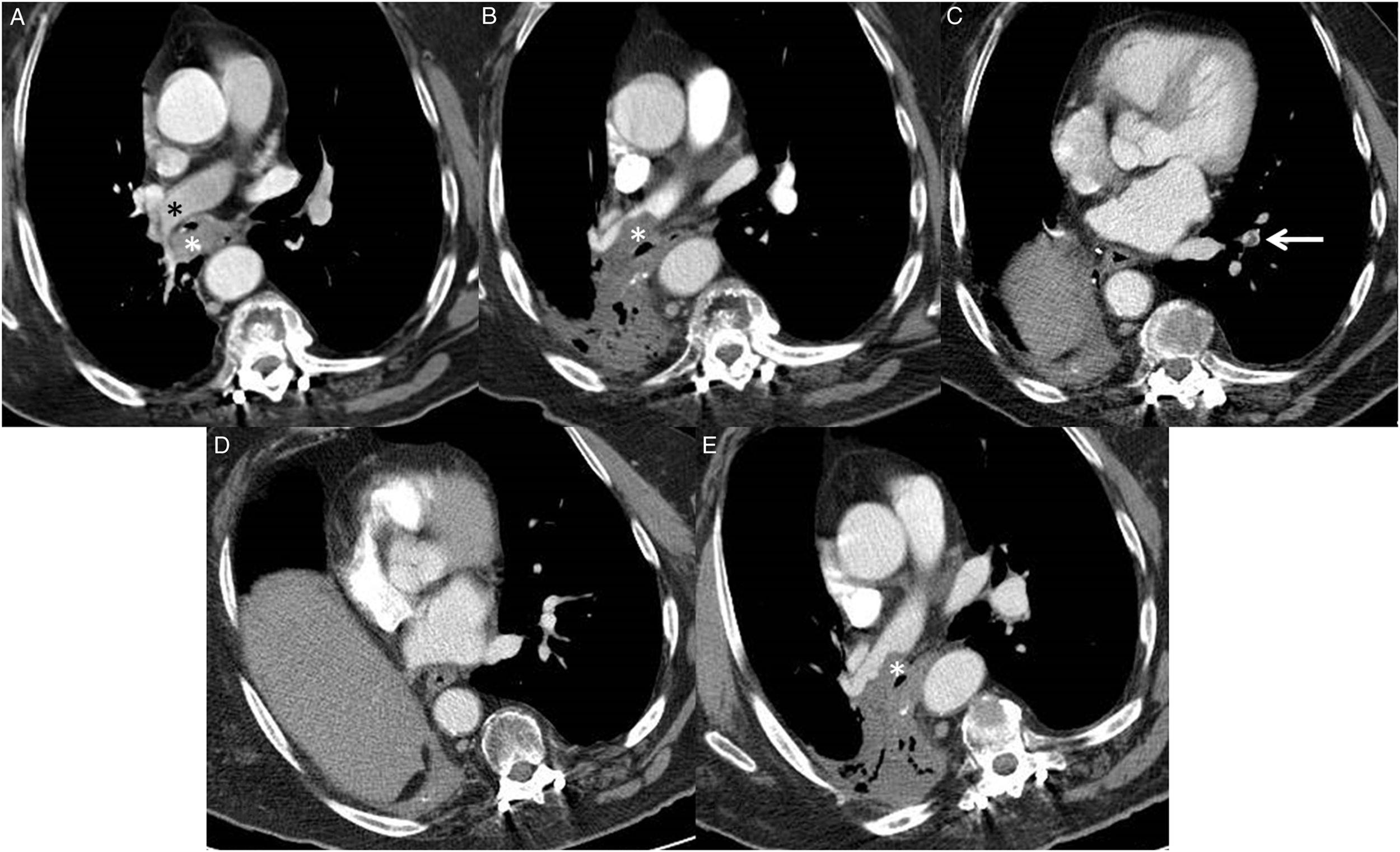 Asymptomatic acute pulmonary embolism in a patient with a delayed ...