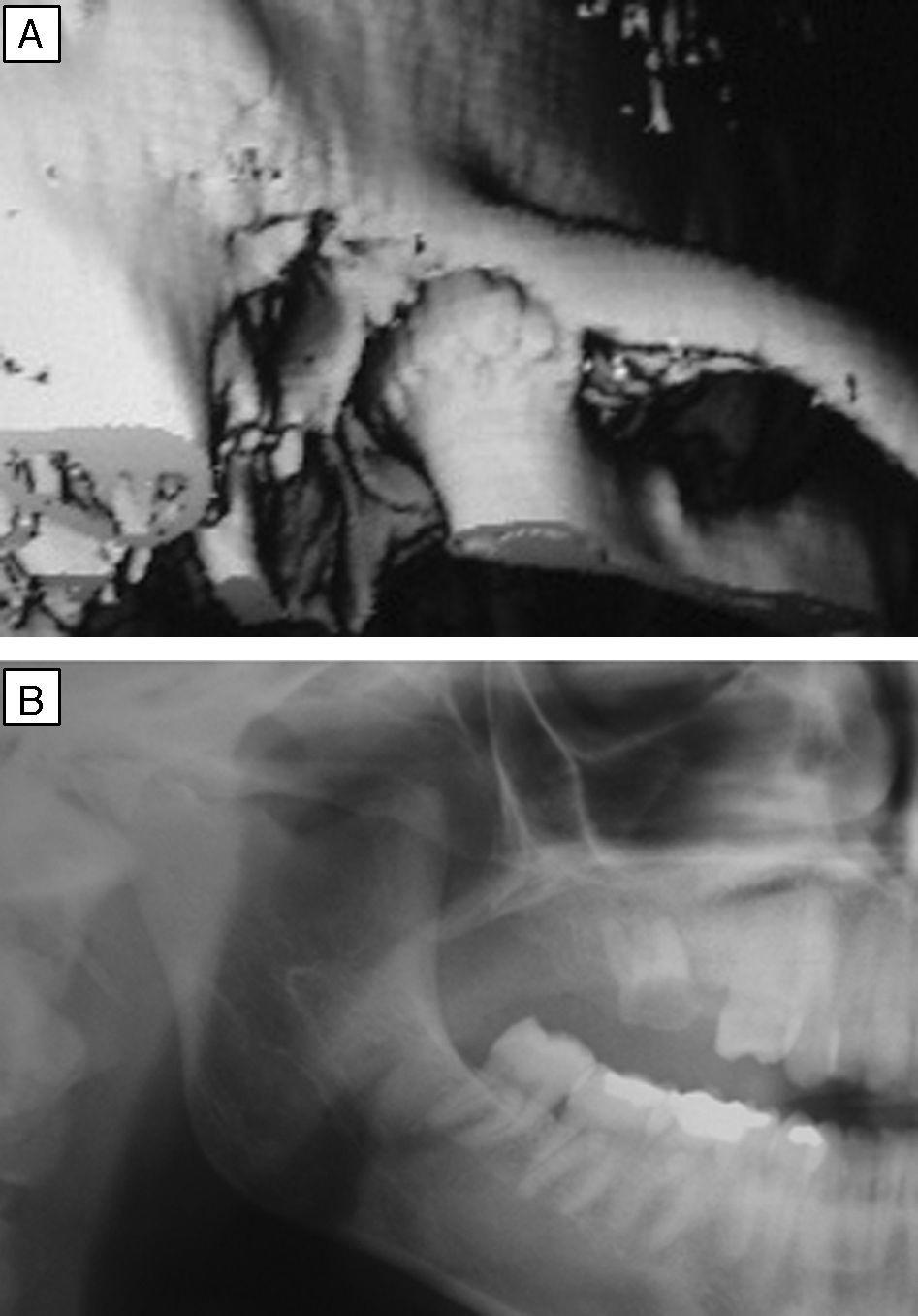 Tratamento de anquilose da articulação temporomandibular. Relato de um ...