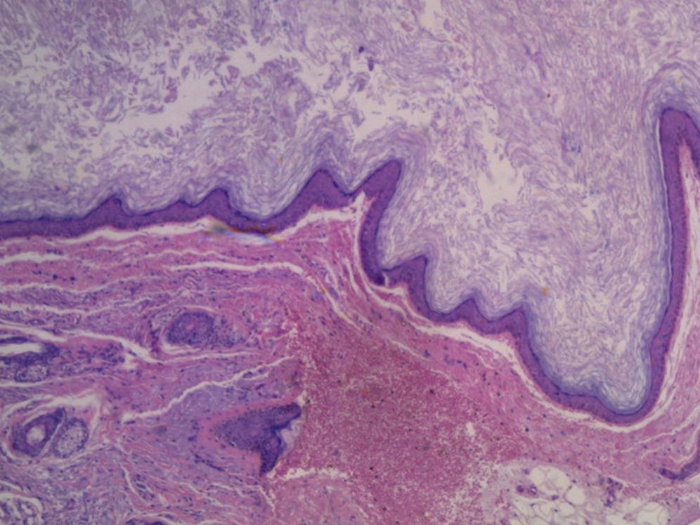 Giant facial dermoid cyst: A case treated by marsupialization | Revista ...