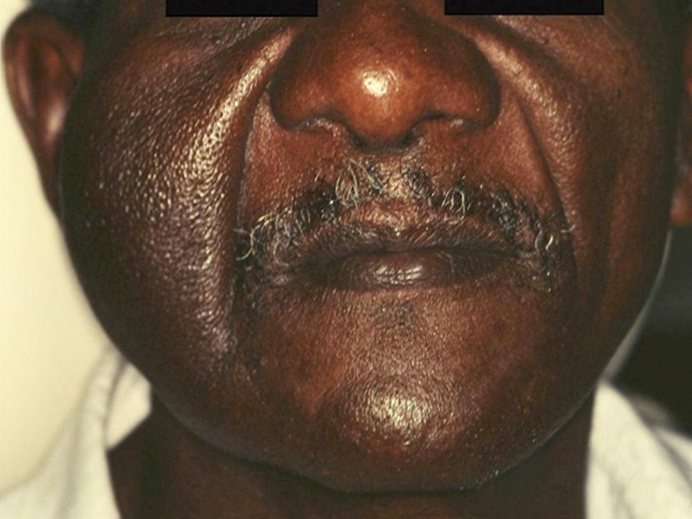 Giant facial dermoid cyst: A case treated by marsupialization | Revista ...