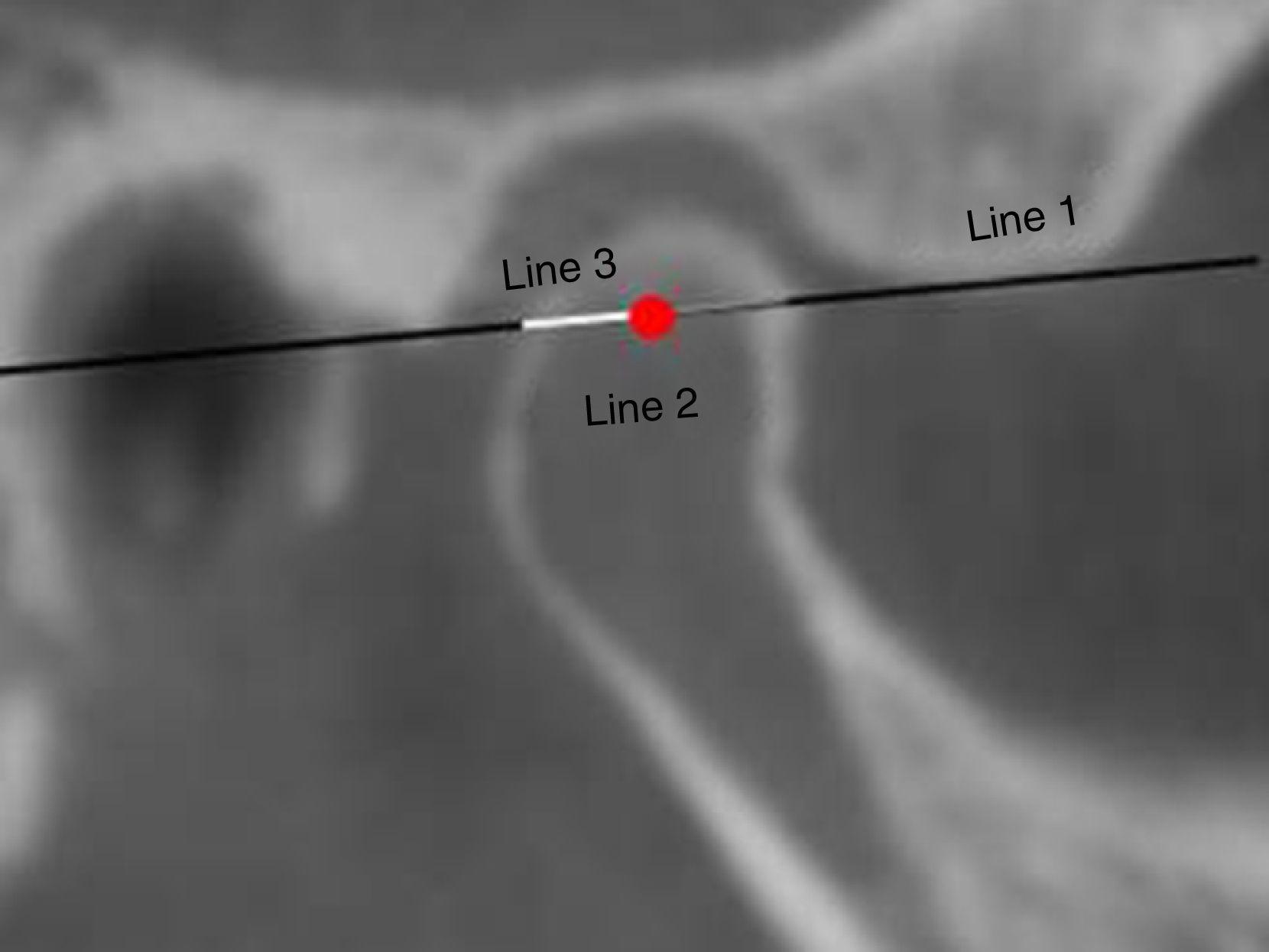 Evaluation of condylar position by CBCT after static and dynamic ...