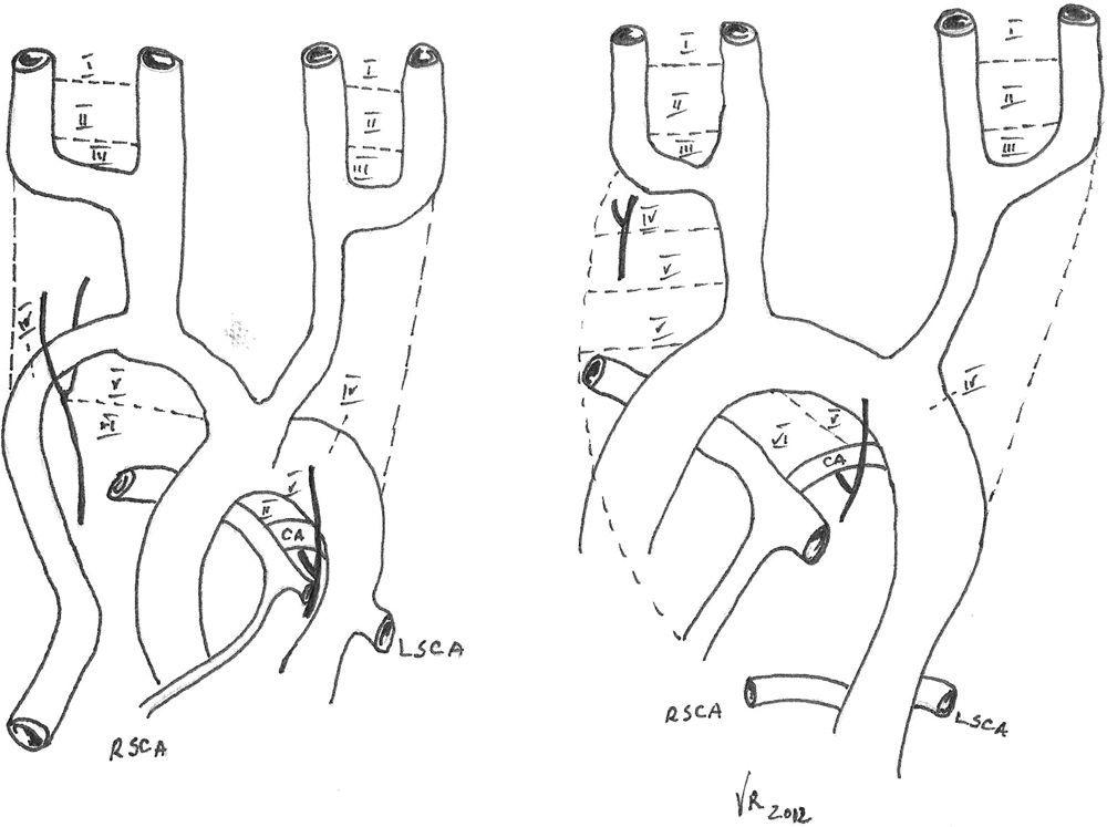 The non-recurrent laryngeal nerve: An anatomical “trap” | Revista ...