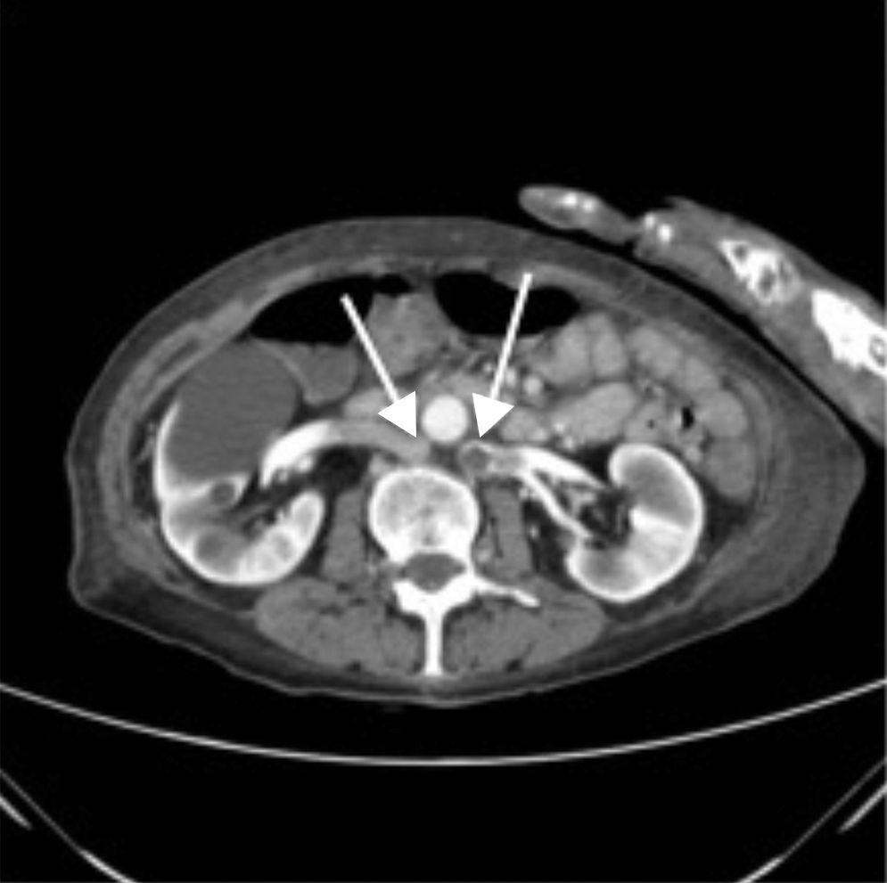 Duplicação da veia cava inferior com drenagem pela veia ázigos. A ...