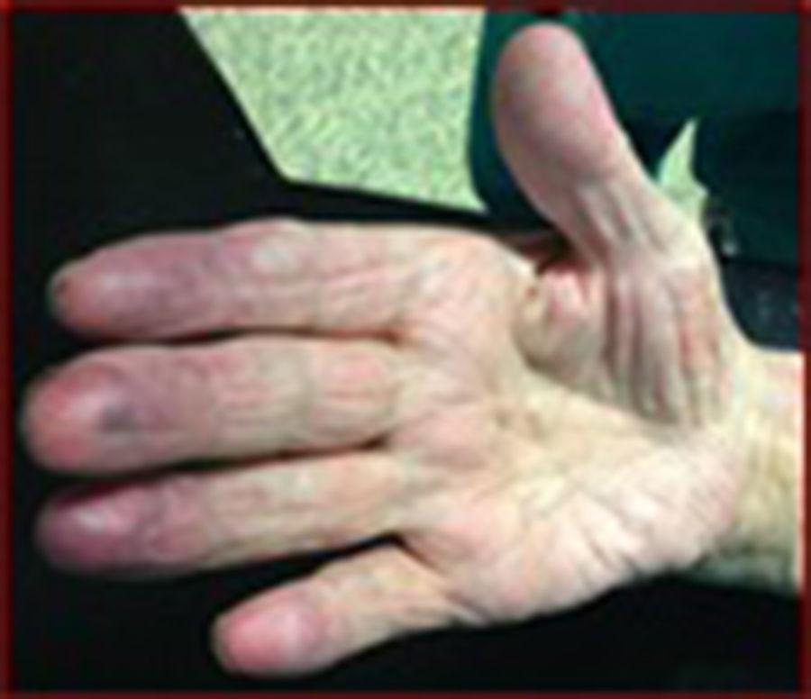 Blue finger syndrome – case report | Angiologia e Cirurgia Vascular