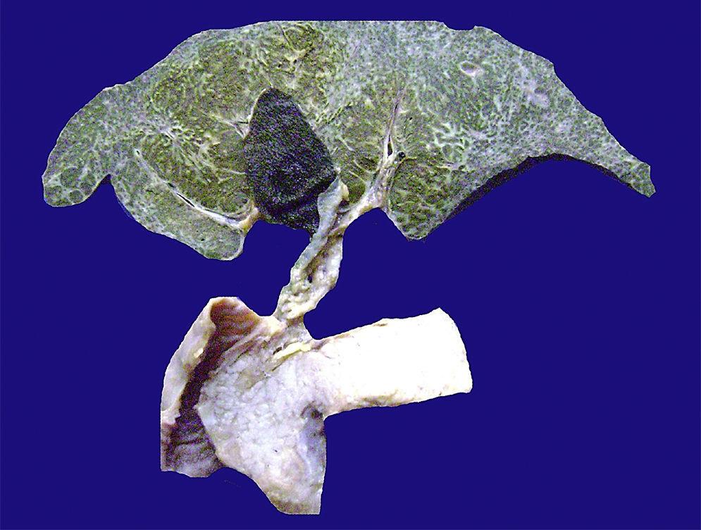 Fibrosis hepática congénita: complicaciones y manejo | Boletín Médico ...