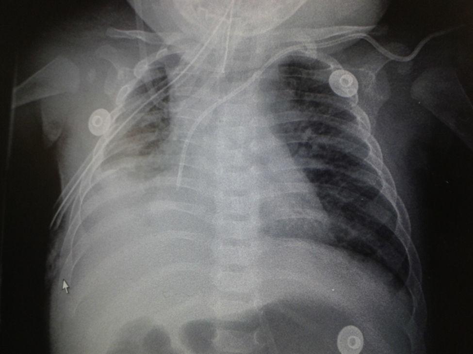 Tuberculosis perinatal | Boletín Médico del Hospital Infantil de México