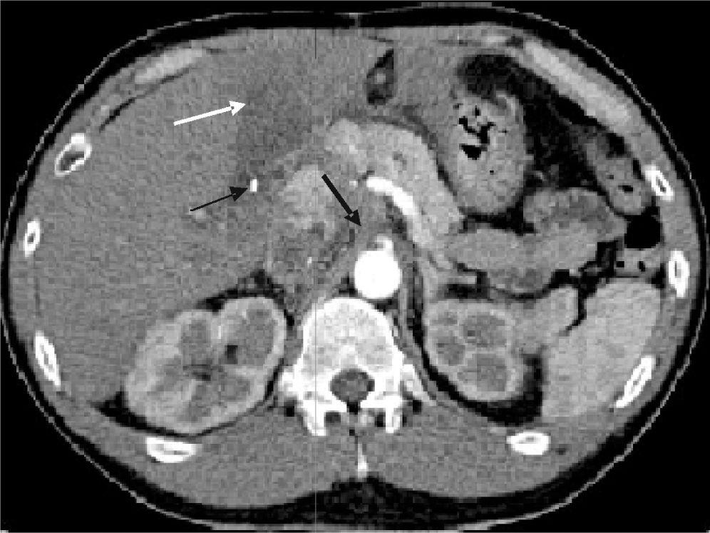 Late acute celiac and hepatic artery thrombosis with portal vein ...