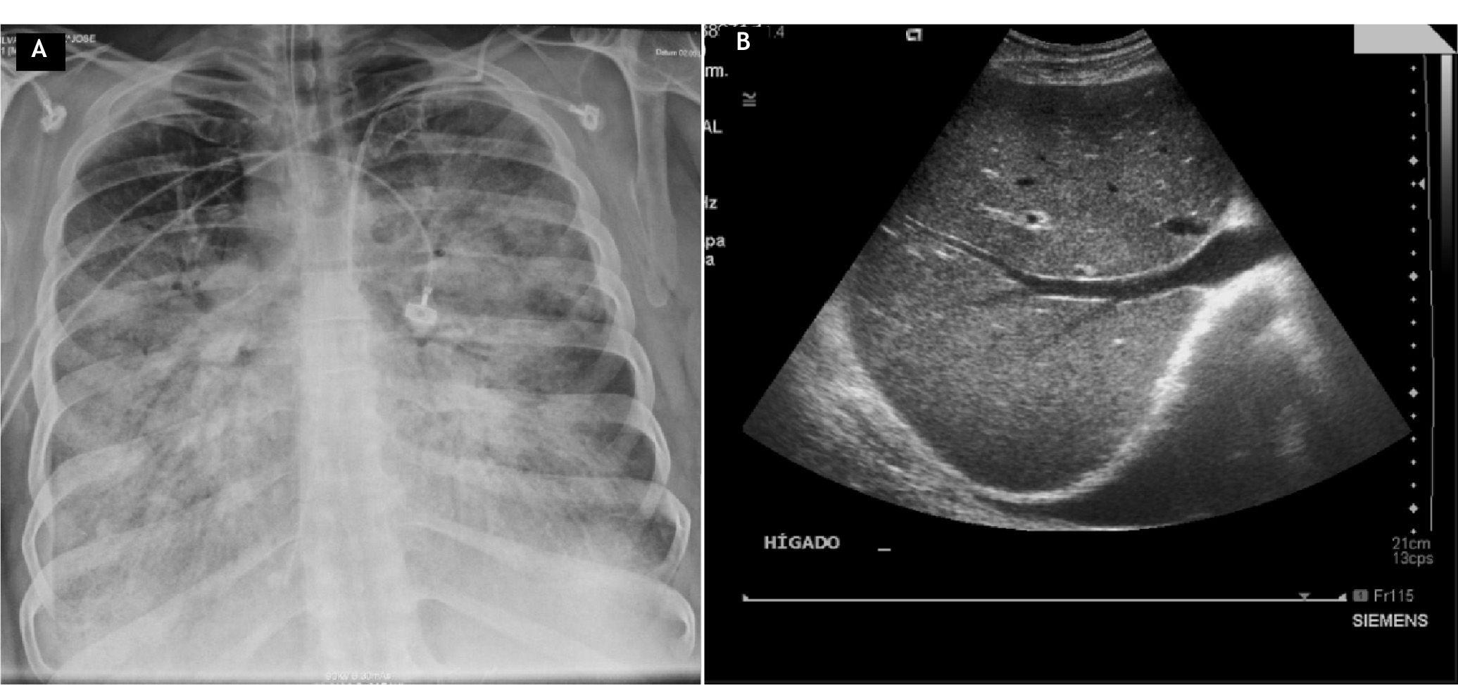 Liver involvement in severe human influenza A H1N1 | Annals of Hepatology