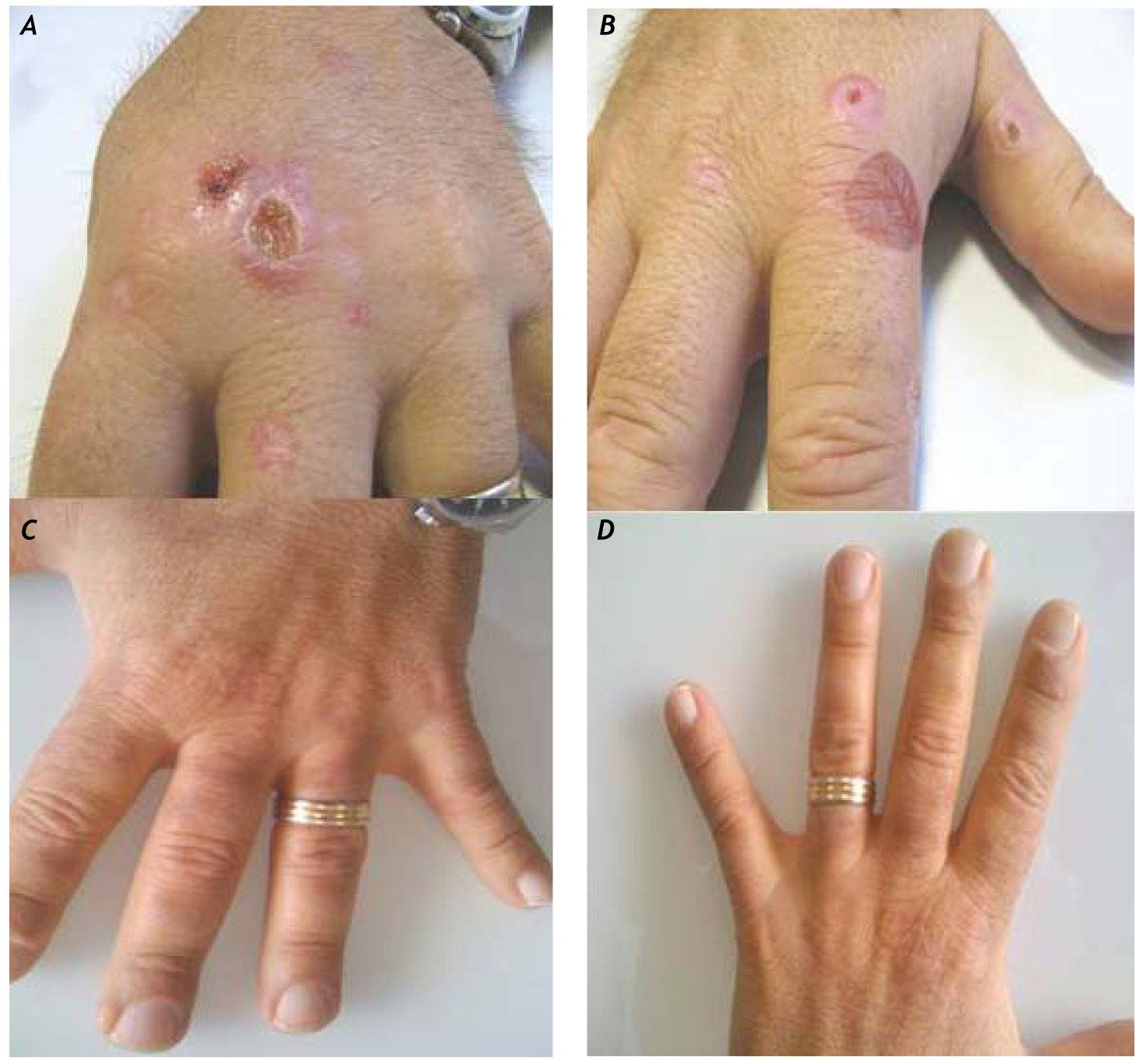 Hepatitis C Pictures Skin