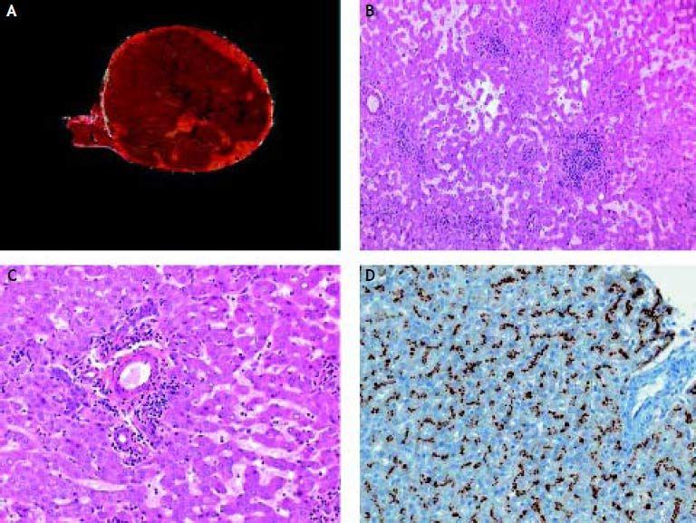 Hepatocellular adenoma: Different entities for a single lesion | Annals ...