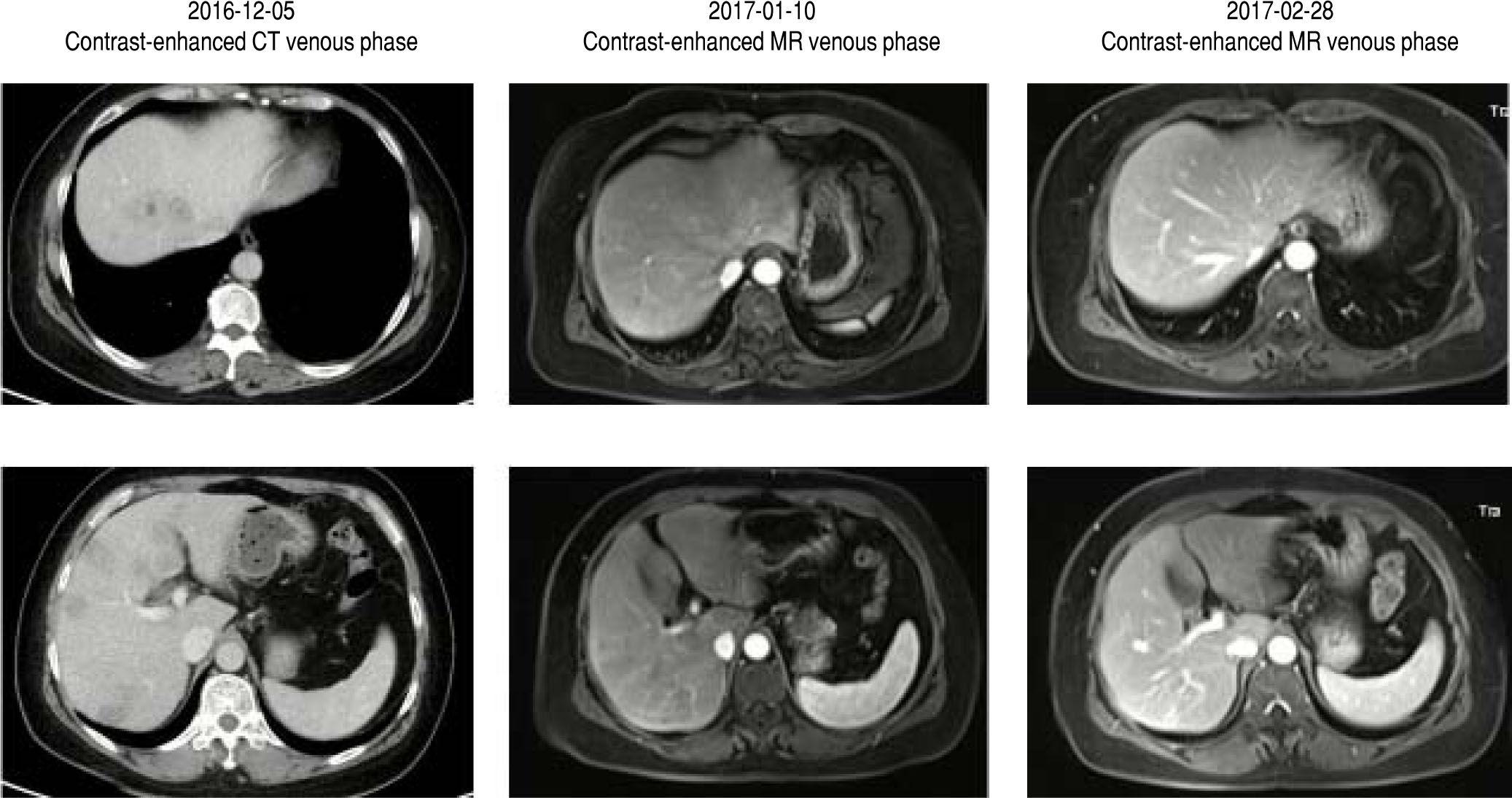 Spontaneous Resolution of Multiple Hepatic Masses: Hepatic Inflammatory ...