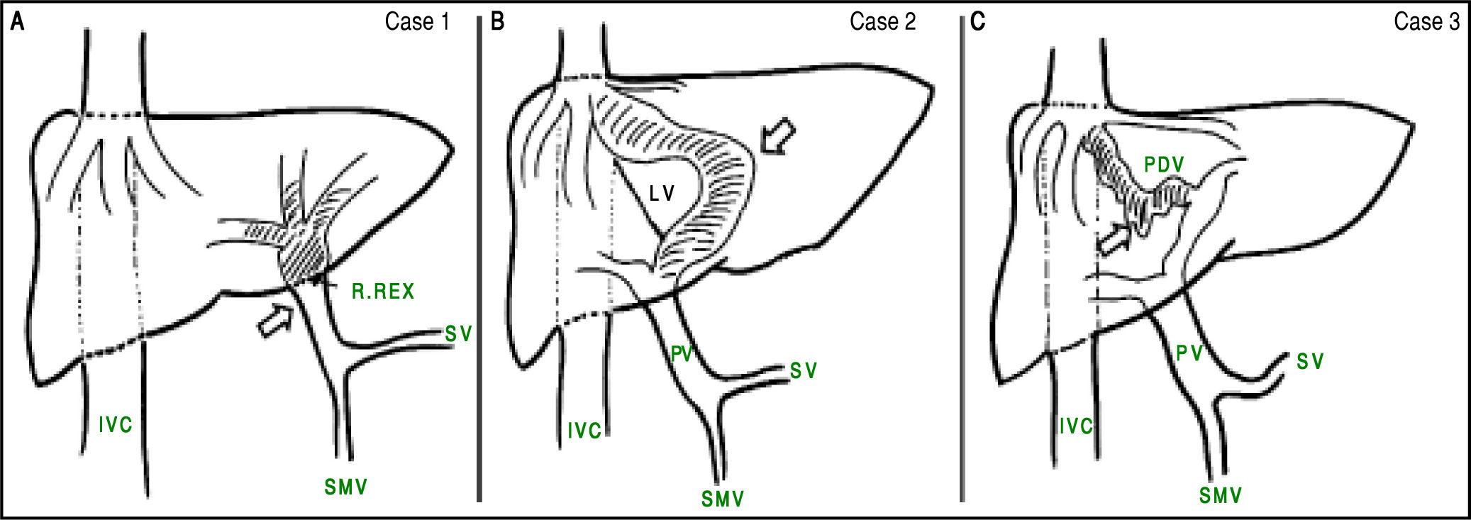 Congenital Shunts of the Portal Venous System: Case-series of Uncommon ...