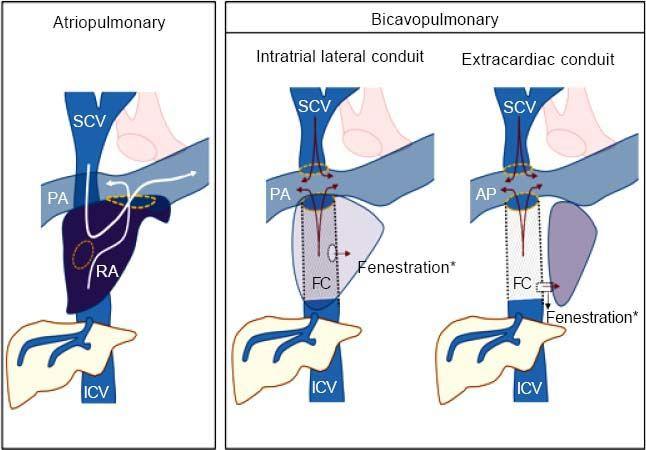 Fontan-Associated Liver Disease: A Review | Annals of Hepatology