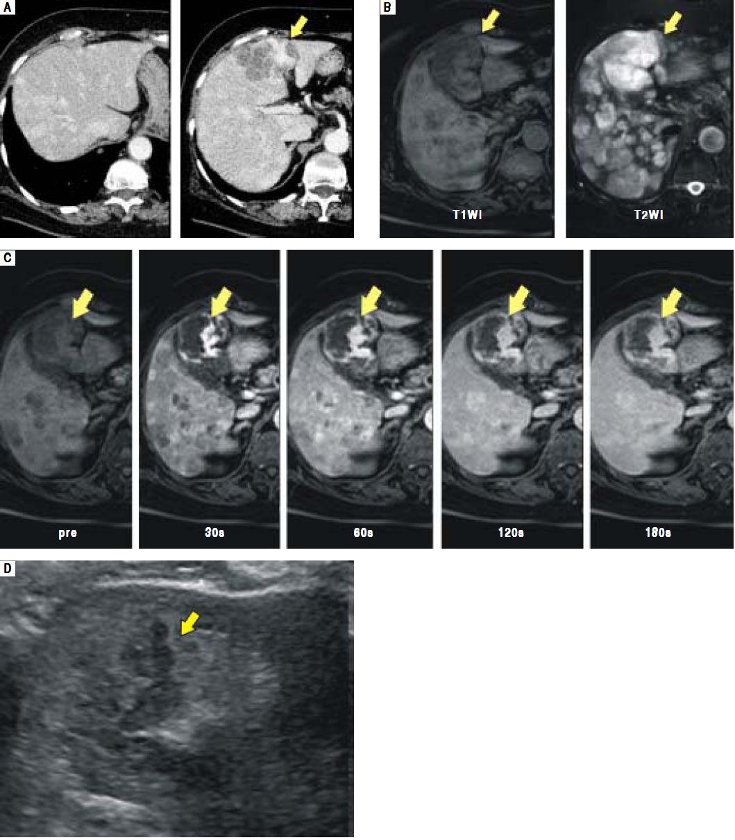 Hepatic Angiosarcoma with Kasabach-Merritt Phenomenon: A Case Report ...