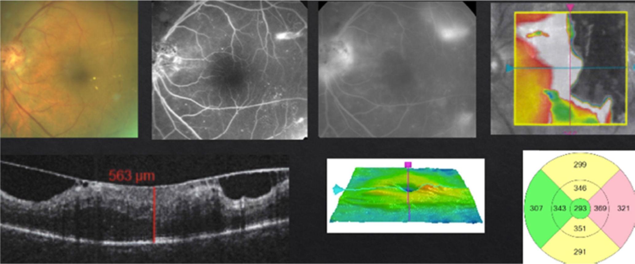 Treatment of Diabetic Macular Edema (DME): Shifting paradigms ...
