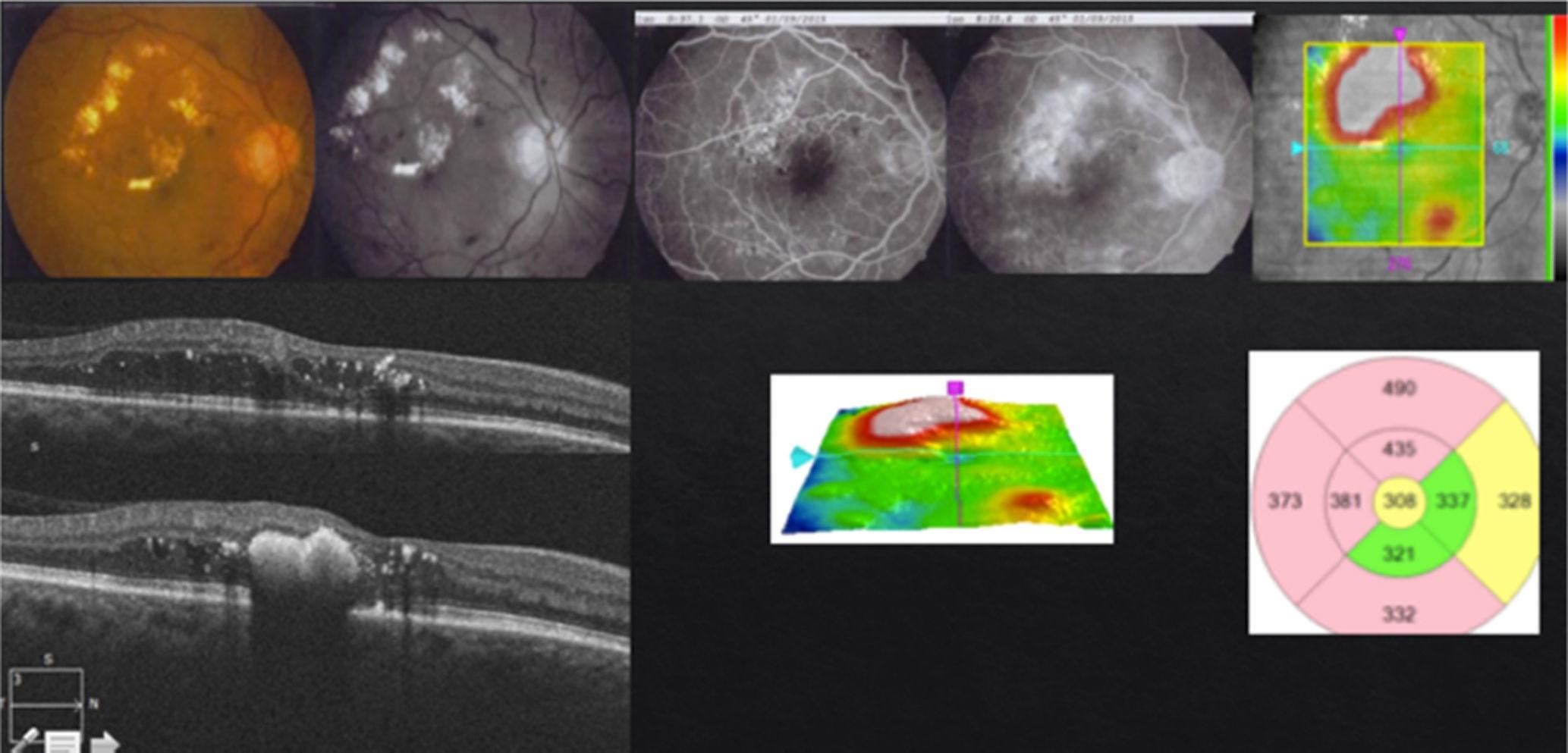 Treatment of Diabetic Macular Edema (DME): Shifting paradigms ...