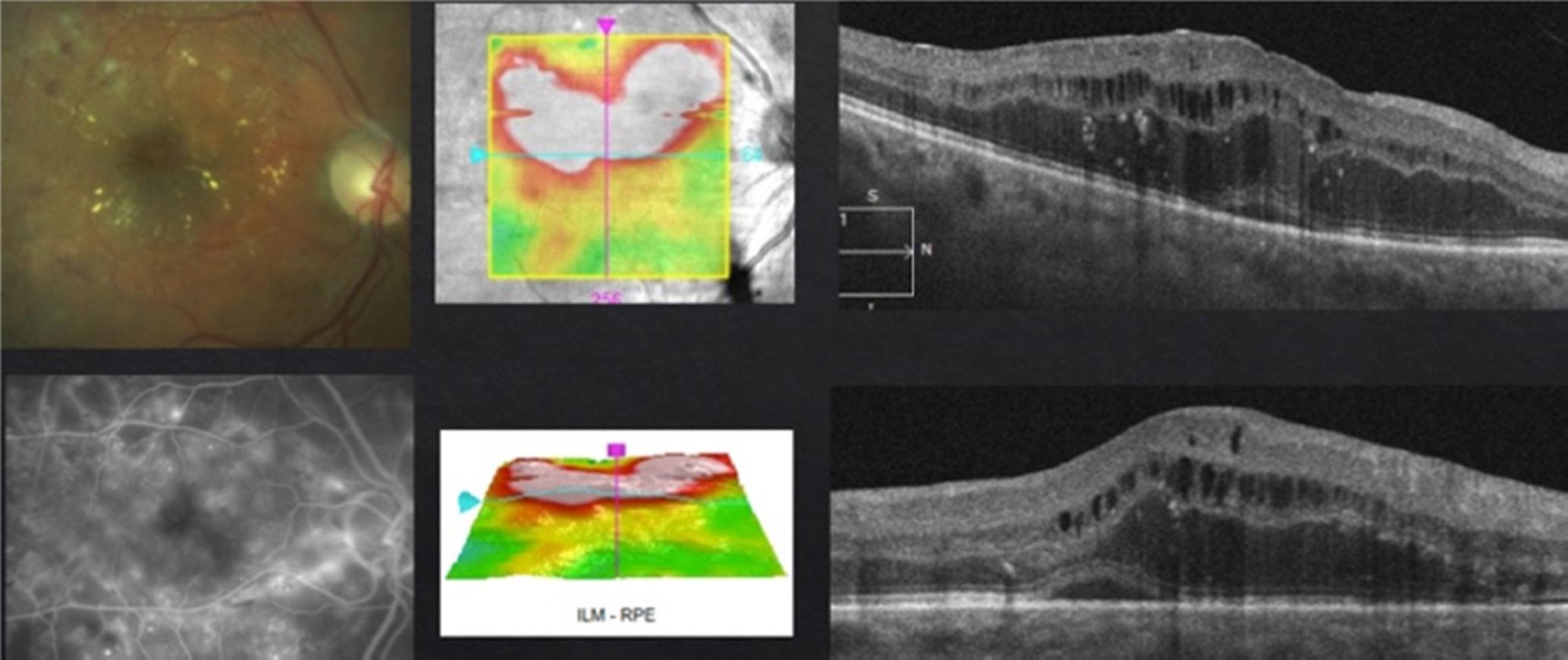 Treatment of Diabetic Macular Edema (DME): Shifting paradigms ...