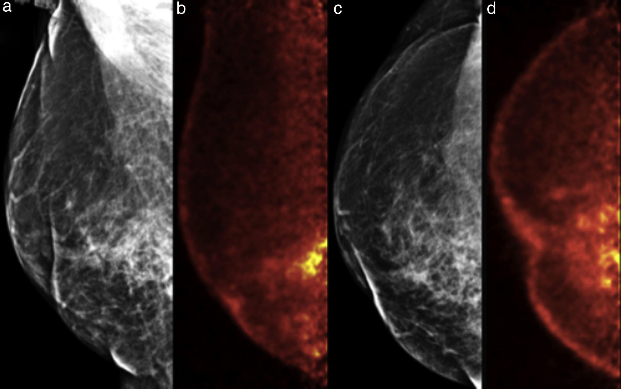 Mastografía por emisión de positrones: revisión de un promisorio ...