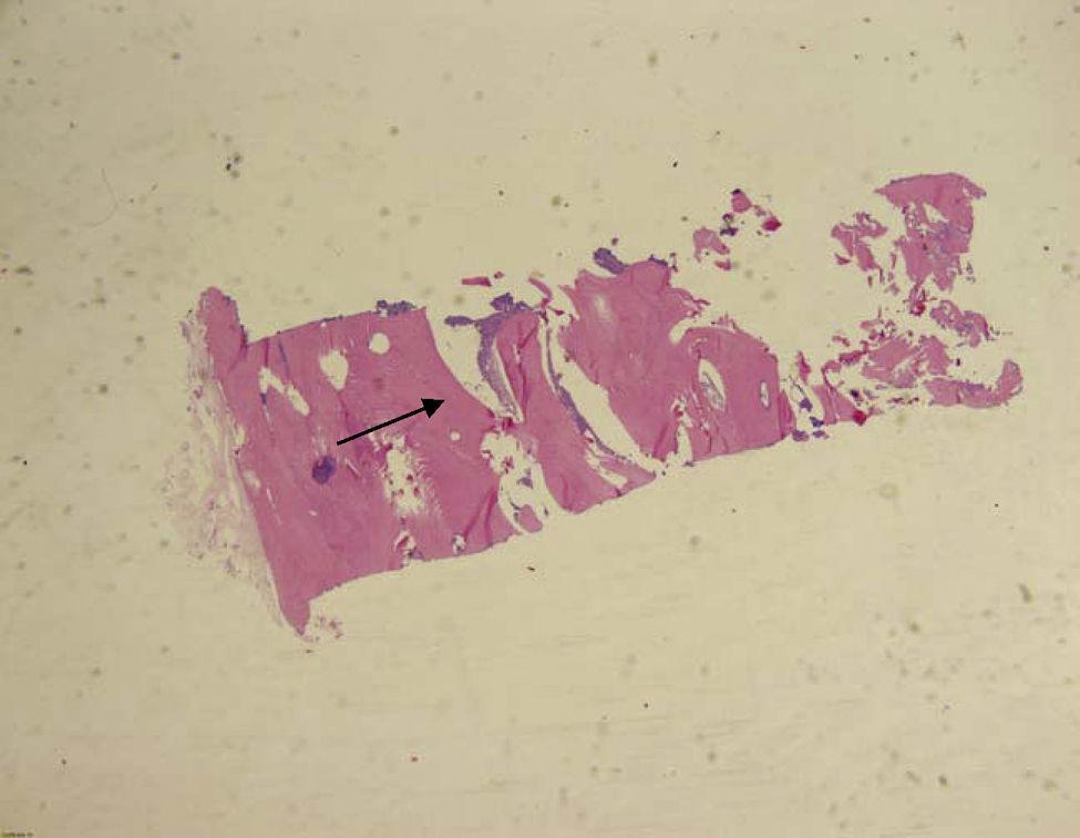 Mieloma múltiple con osteoesclerosis difusa: reporte de caso | Gaceta ...
