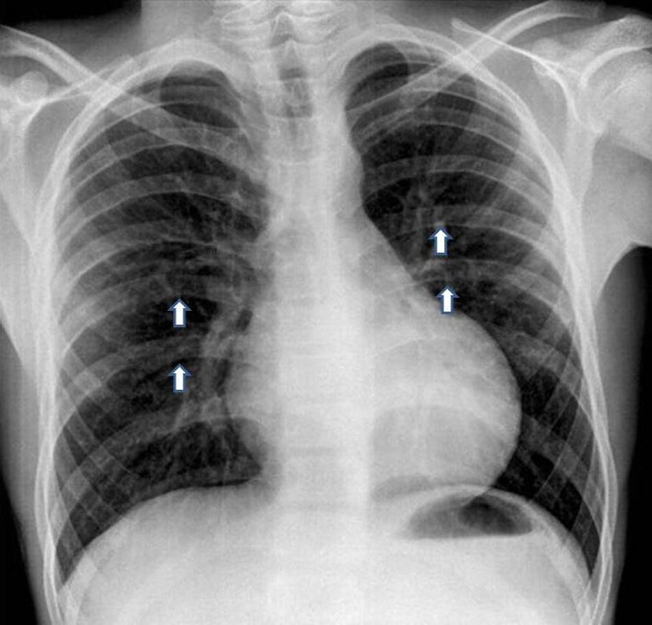 Tratamiento percutáneo simultáneo de coartación aórtica y ductus ...