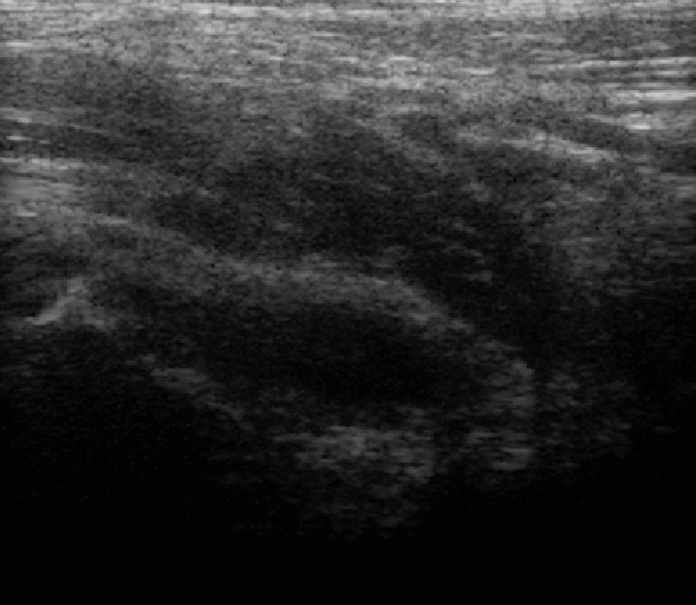 Diferenciación de sinovitis transitoria y artritis séptica de cadera ...