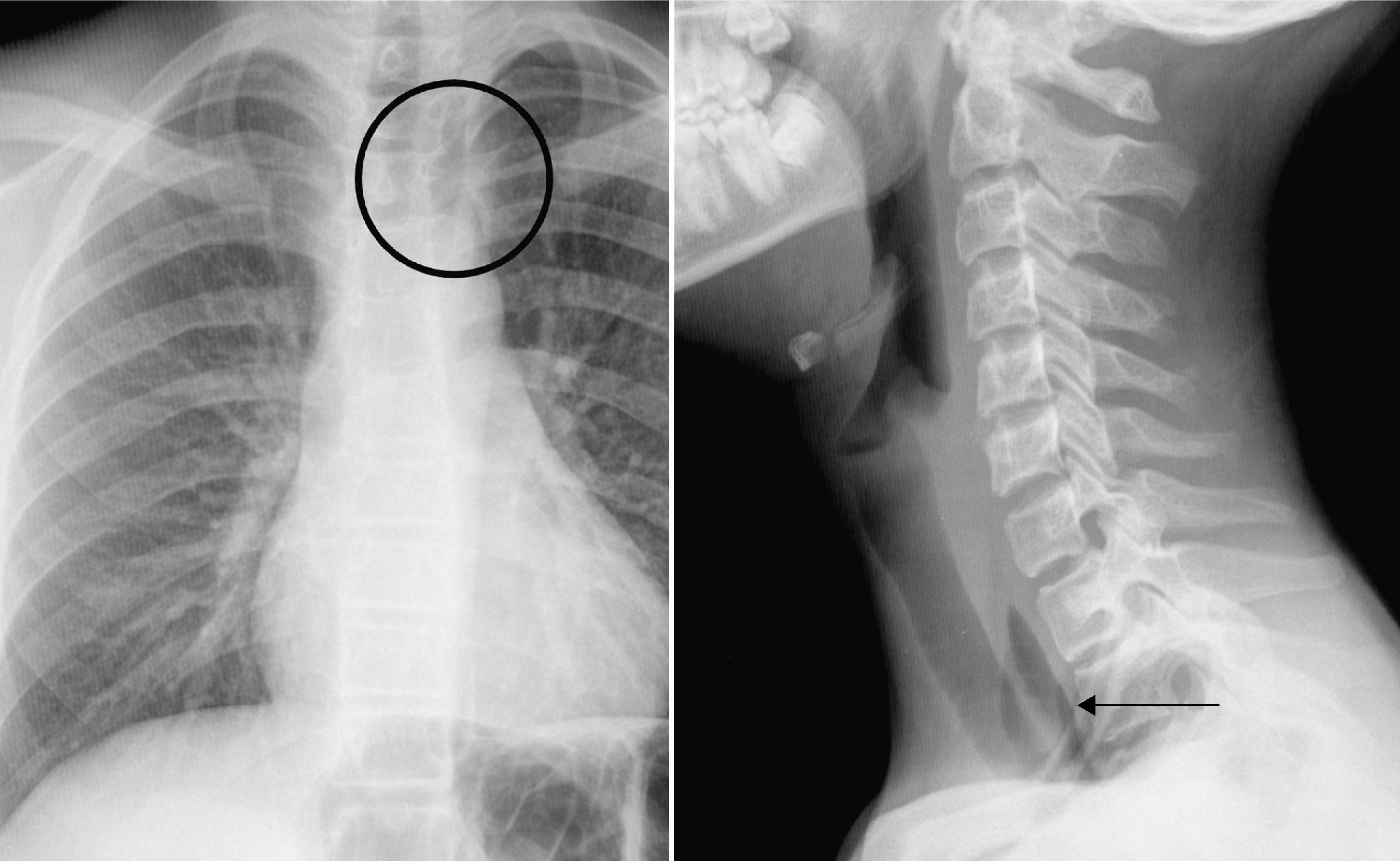 Tos seca y estridor debidos exclusivamente a acalasia esofágica ...