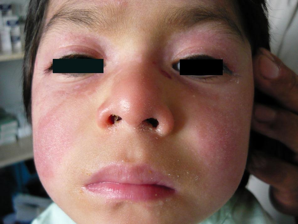 Niña con calcinosis y manifestaciones dermatológicas de conectivopatía ...