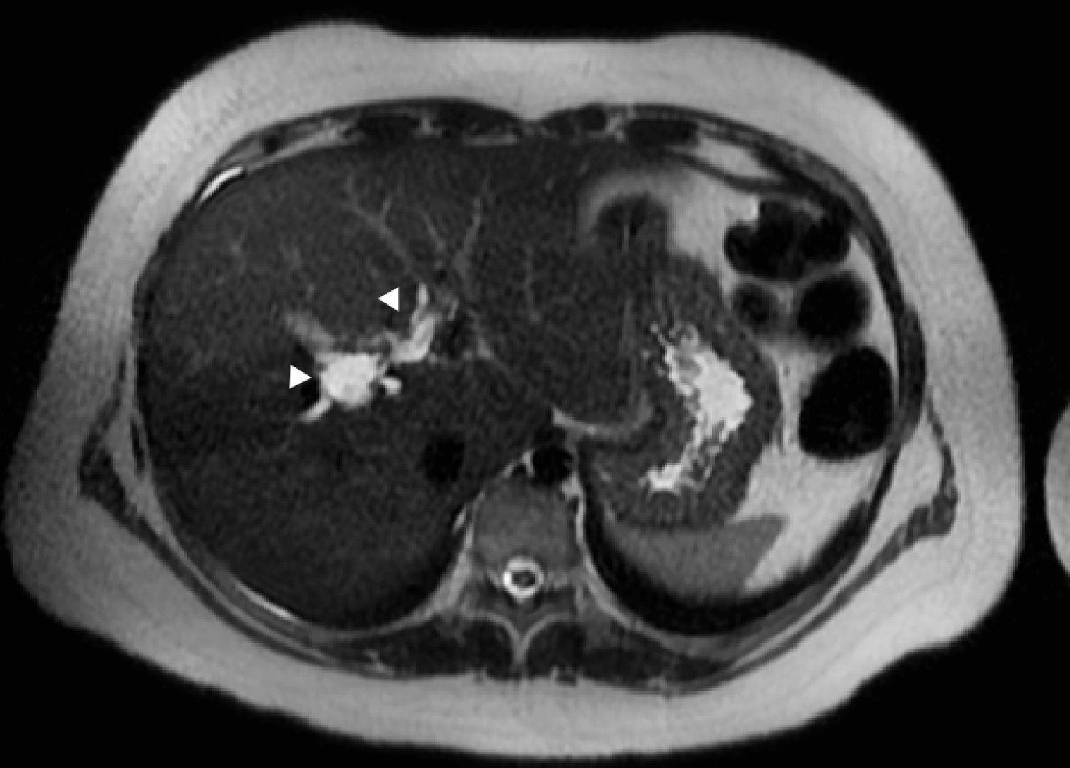 Quiste de colédoco como causa de dolor epigástrico | Anales de Pediatría