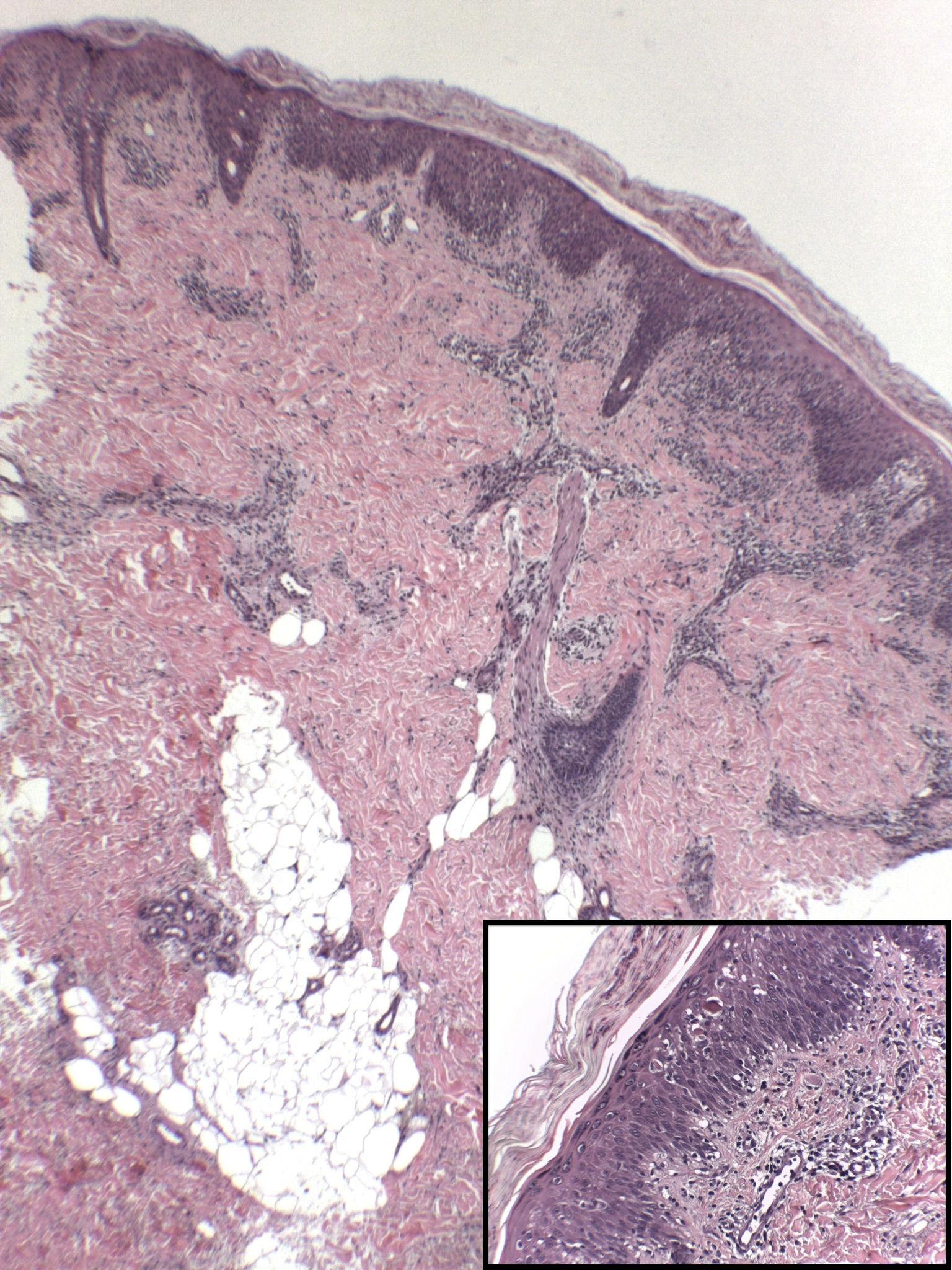 Pitiriasis liquenoide y varioliforme aguda | Anales de Pediatría