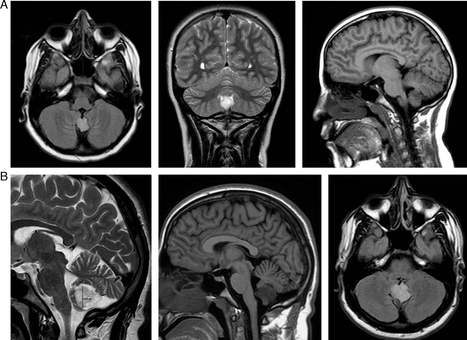 Síndrome afectivo-cognitivo cerebeloso secundario a tumor cerebeloso ...