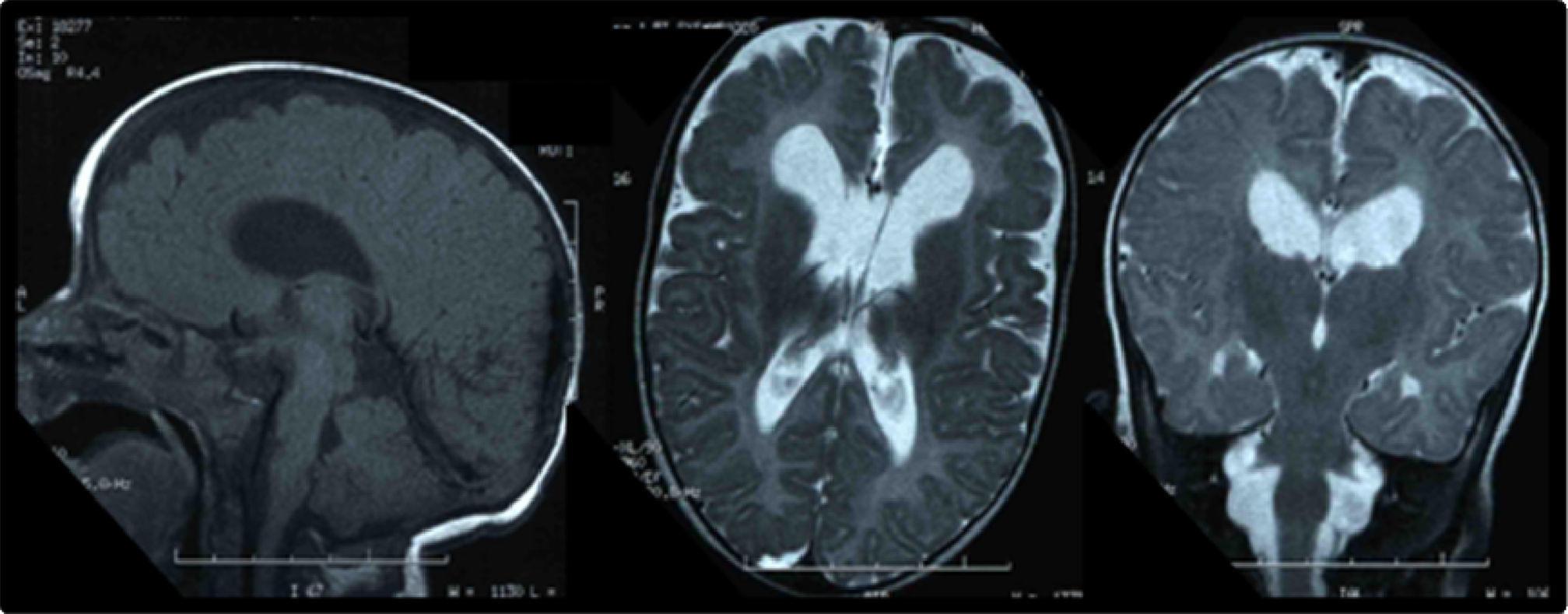 Síndrome Schinzel-Giedion: nueva mutación en SETBP1 | Anales de Pediatría